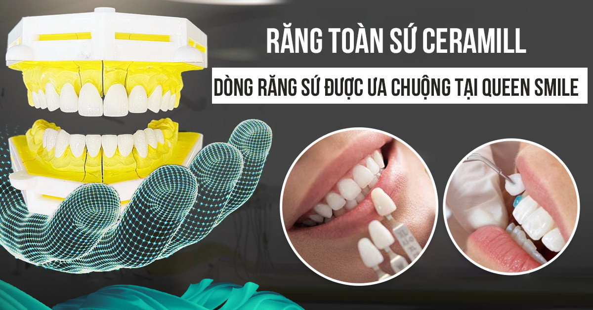 Răng sứ Ceramill | Răng sứ được ưa chuộng tại Nha khoa Queen Smile