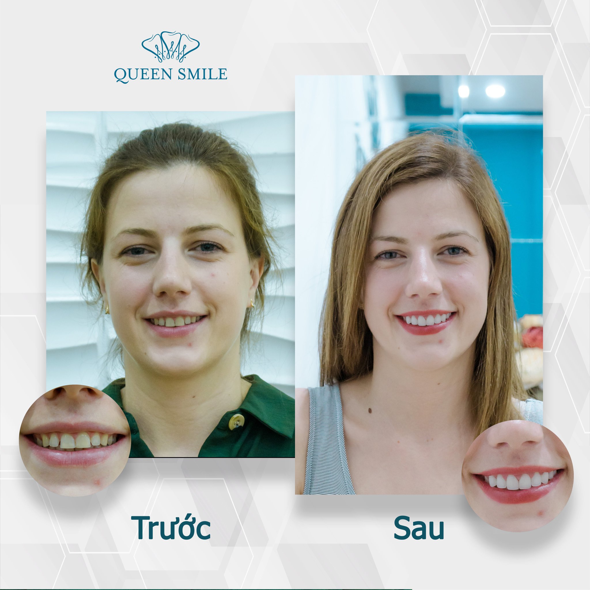 Địa chỉ bọc răng sứ đẹp ở Hà Nội - Nha khoa thẩm mỹ Queen Smile