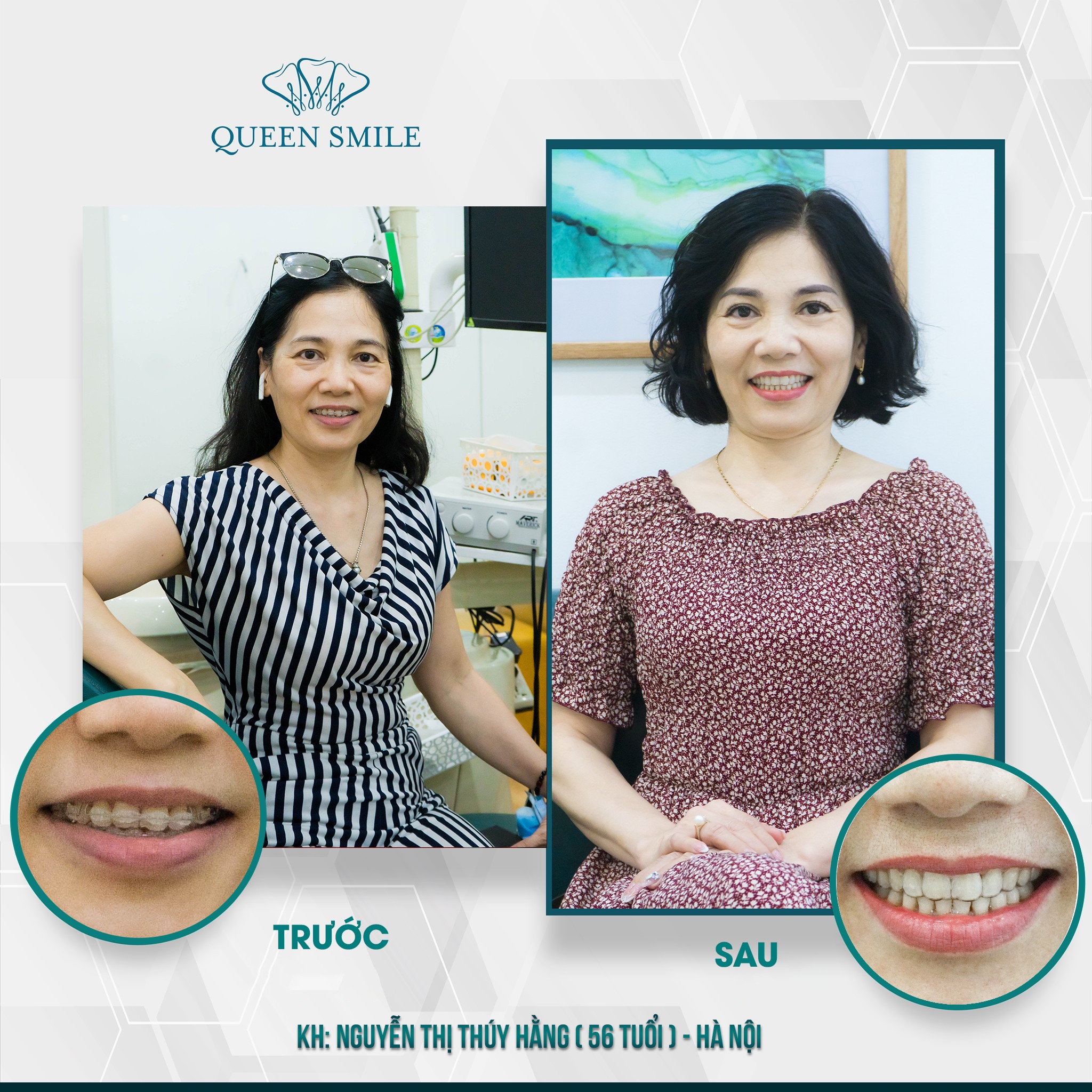 Địa chỉ bọc răng sứ đẹp ở Hà Nội - Nha khoa thẩm mỹ Queen Smile